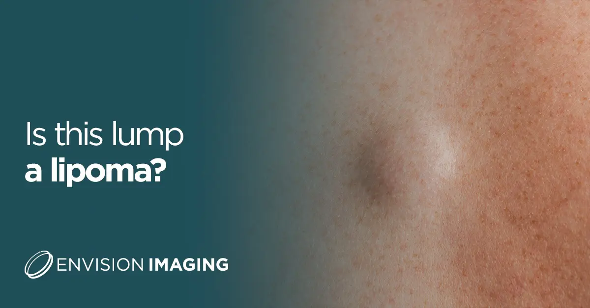 Lipoma In Thigh Muscle